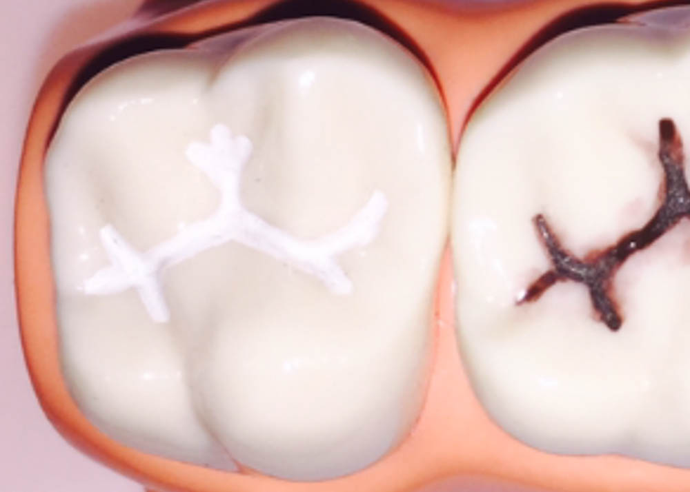 What is the role of sealants in the prevention of tooth decay?