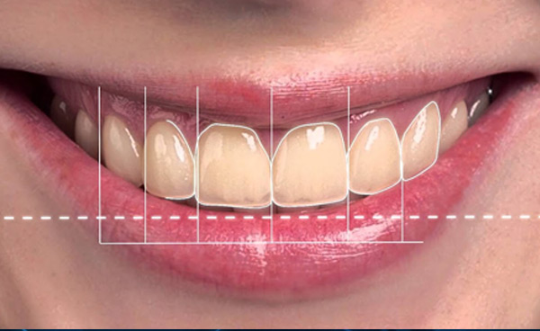 Le sourire parfait, ça existe