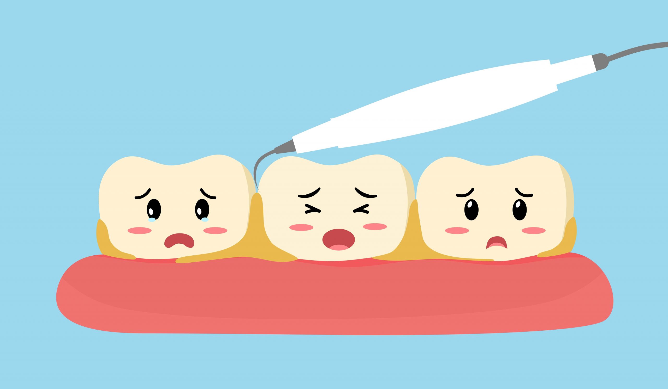 Le tartre en 3 points